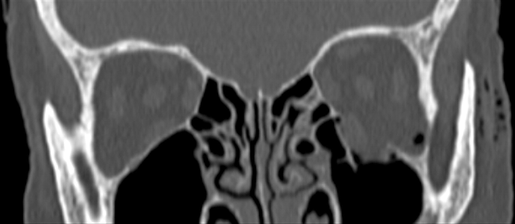 A woman with peri-orbital emphysema | Emergency Medicine Journal