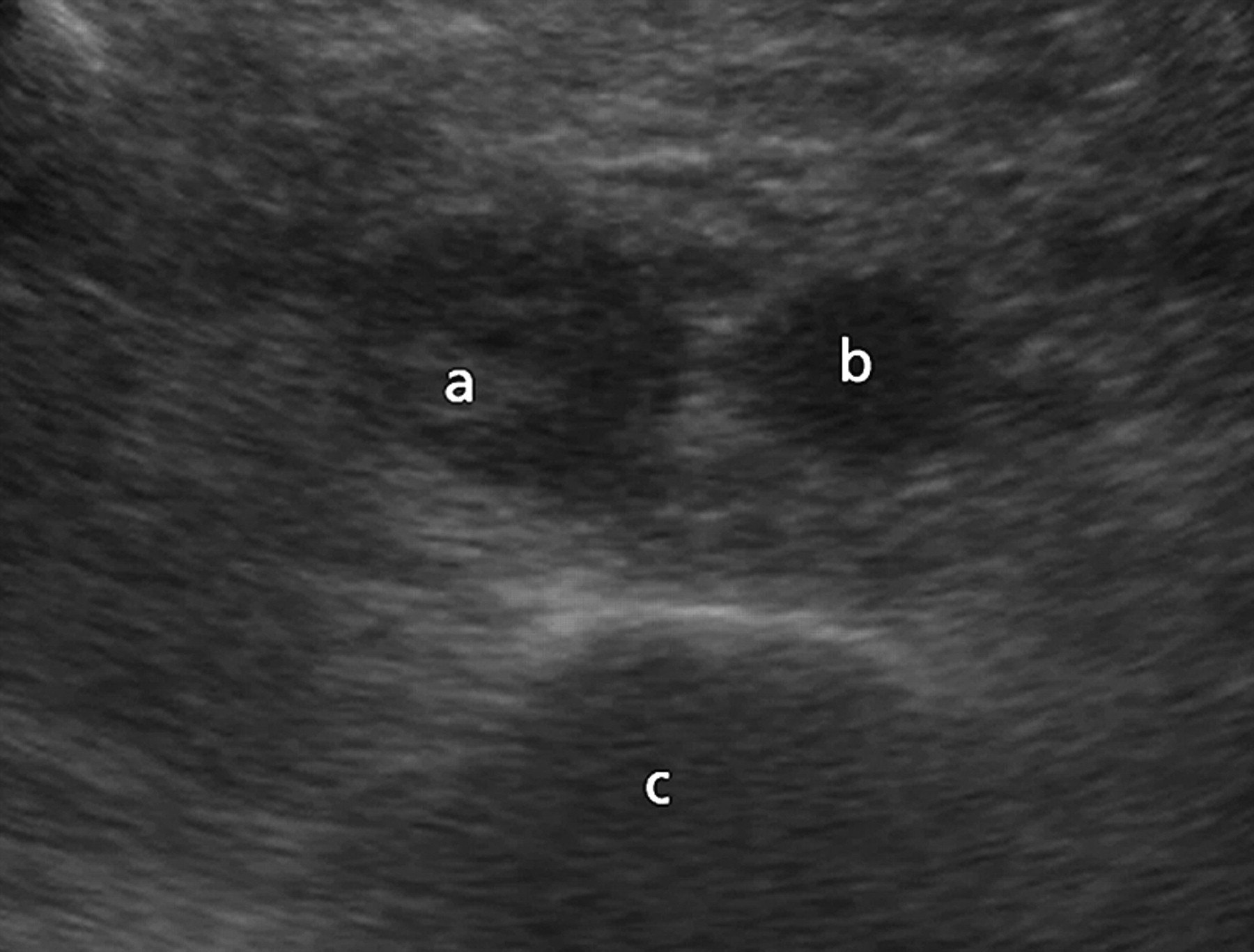 An early diagnosis of inferior vena cava thrombosis | Emergency ...