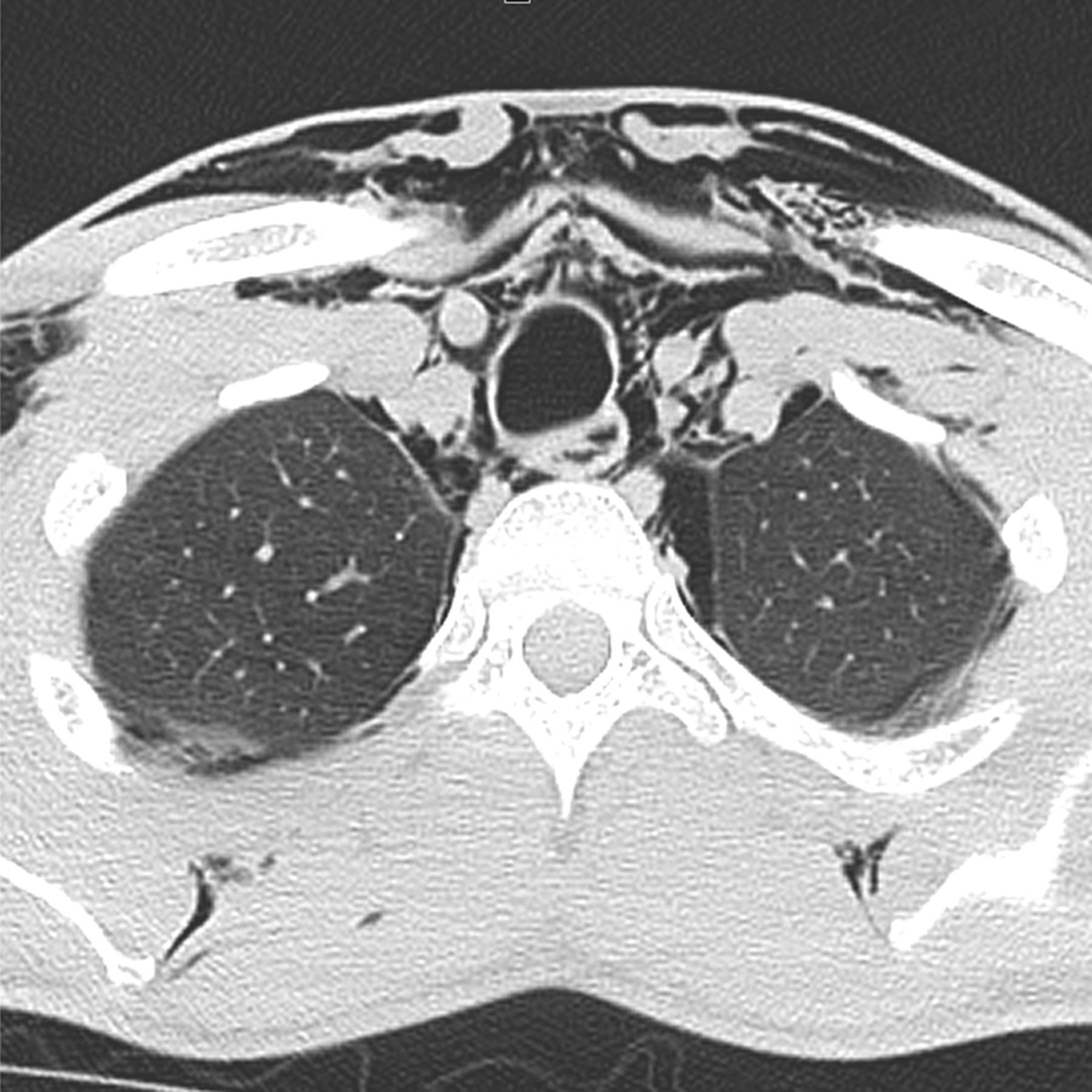 Pneumomediastinum and pulmonary interstitial emphysema after tracheal ...