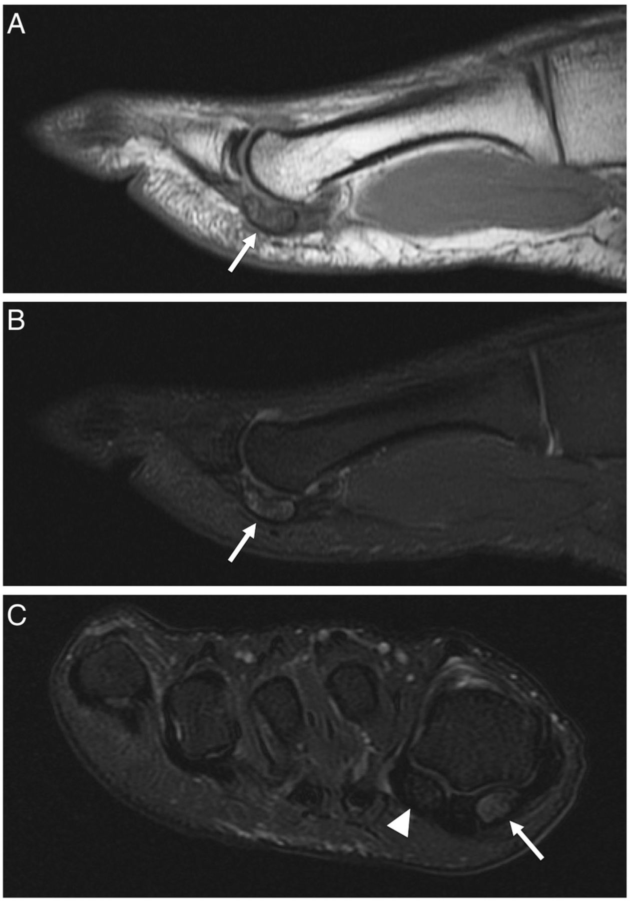 Osseous injuries of the foot: an imaging review. Part 1: the forefoot ...