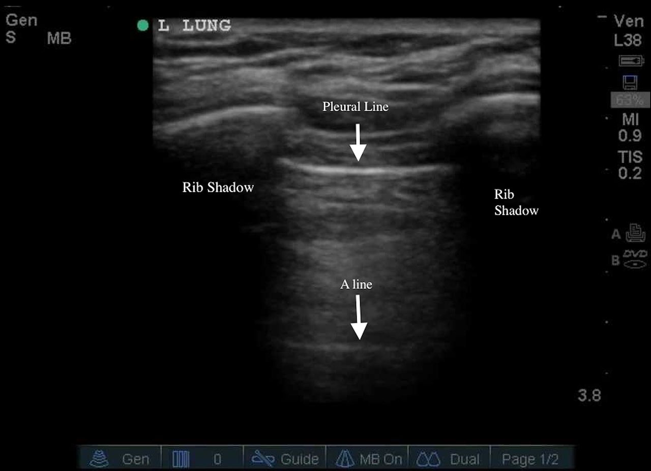 Lung ultrasound: a useful tool in the assessment of the dyspnoeic ...