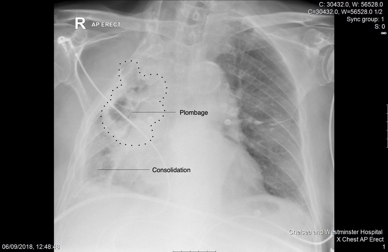 Curious CXR | Emergency Medicine Journal
