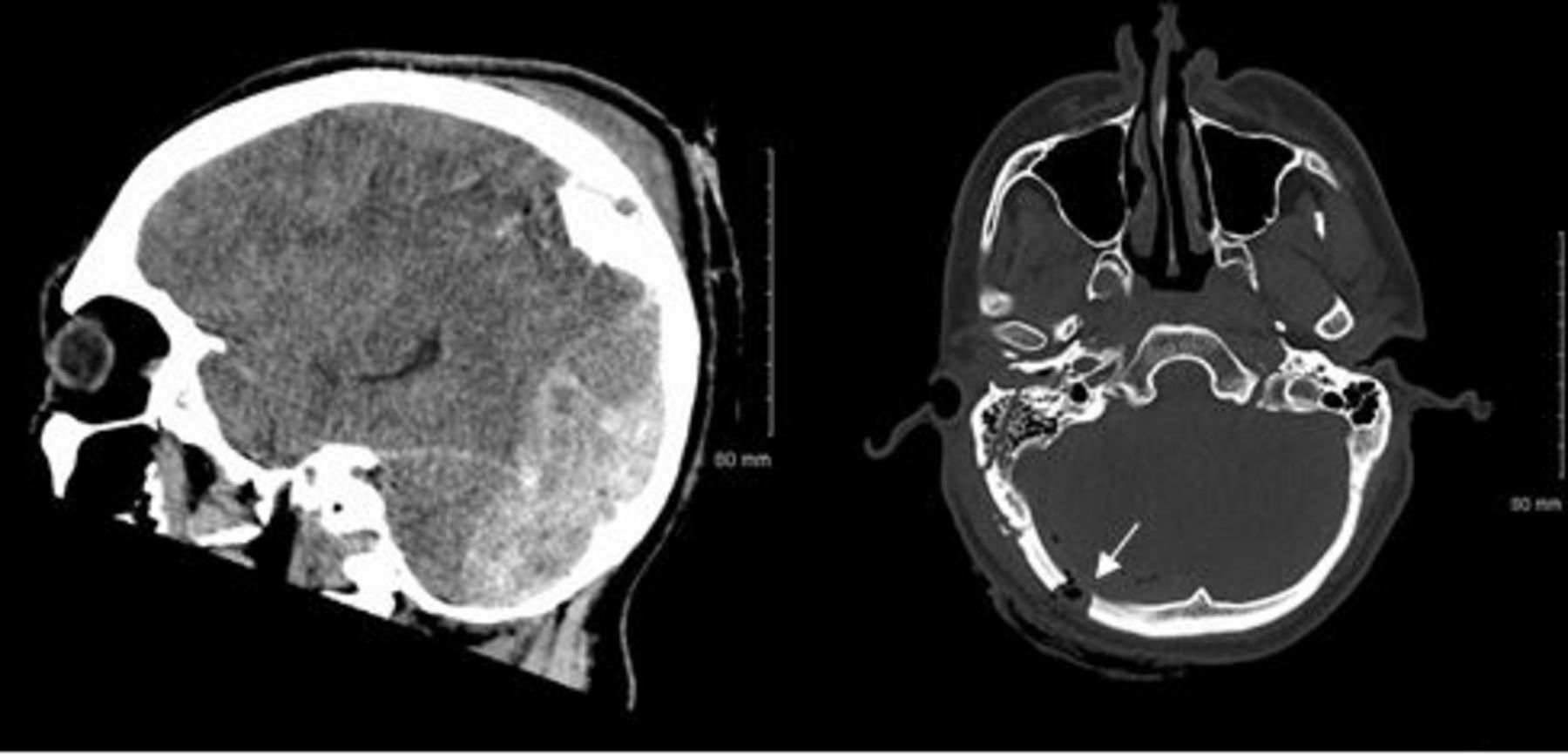 Cranial burr holes in the emergency department: to drill or not to ...