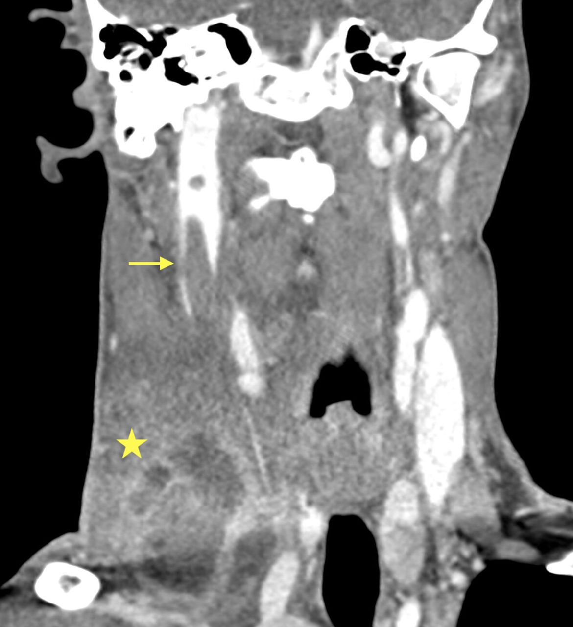 Right-sided neck pain in an intravenous drug user | Emergency Medicine ...