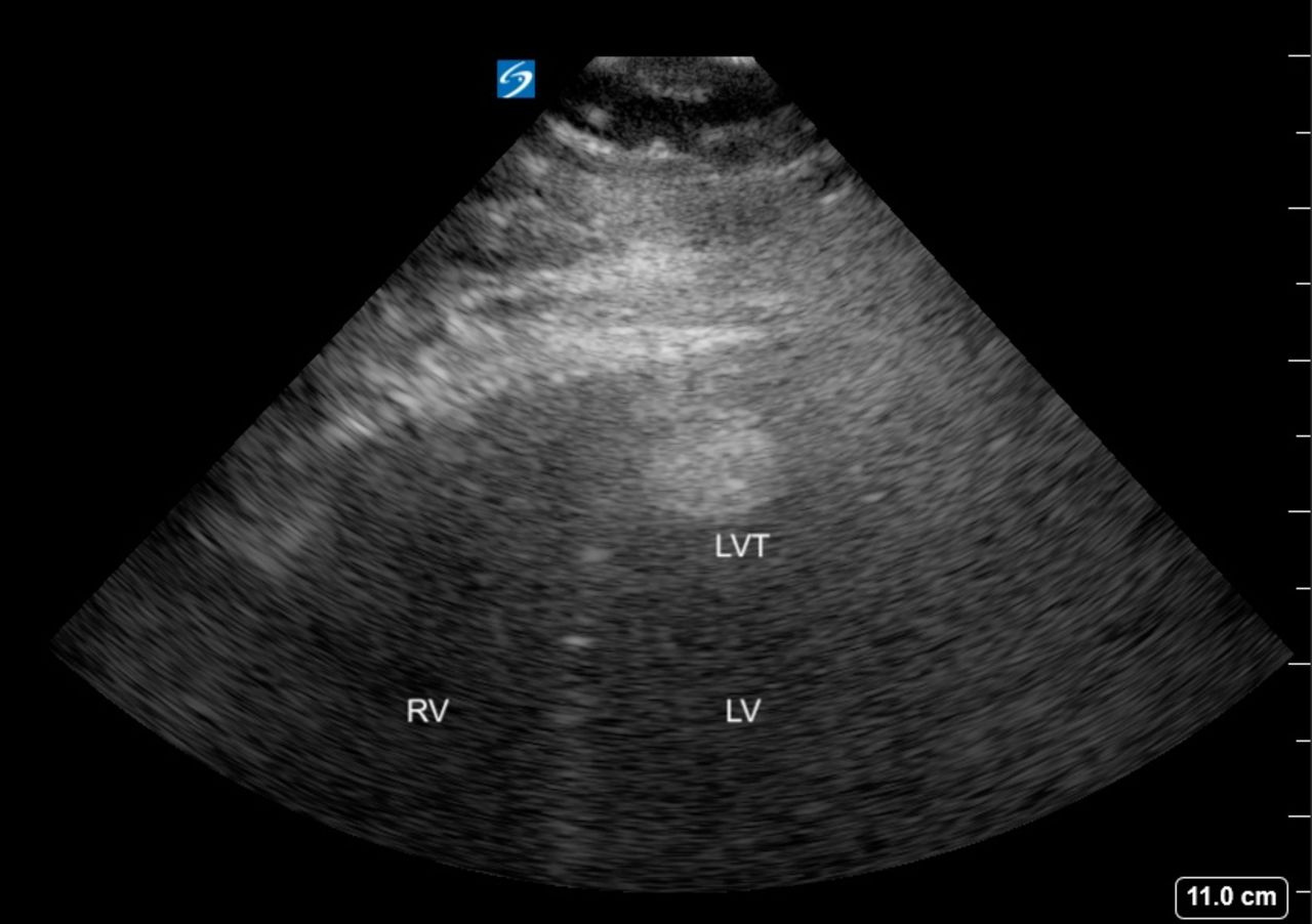 How to recognise an LV thrombus when you see one: a review of cardiac ...