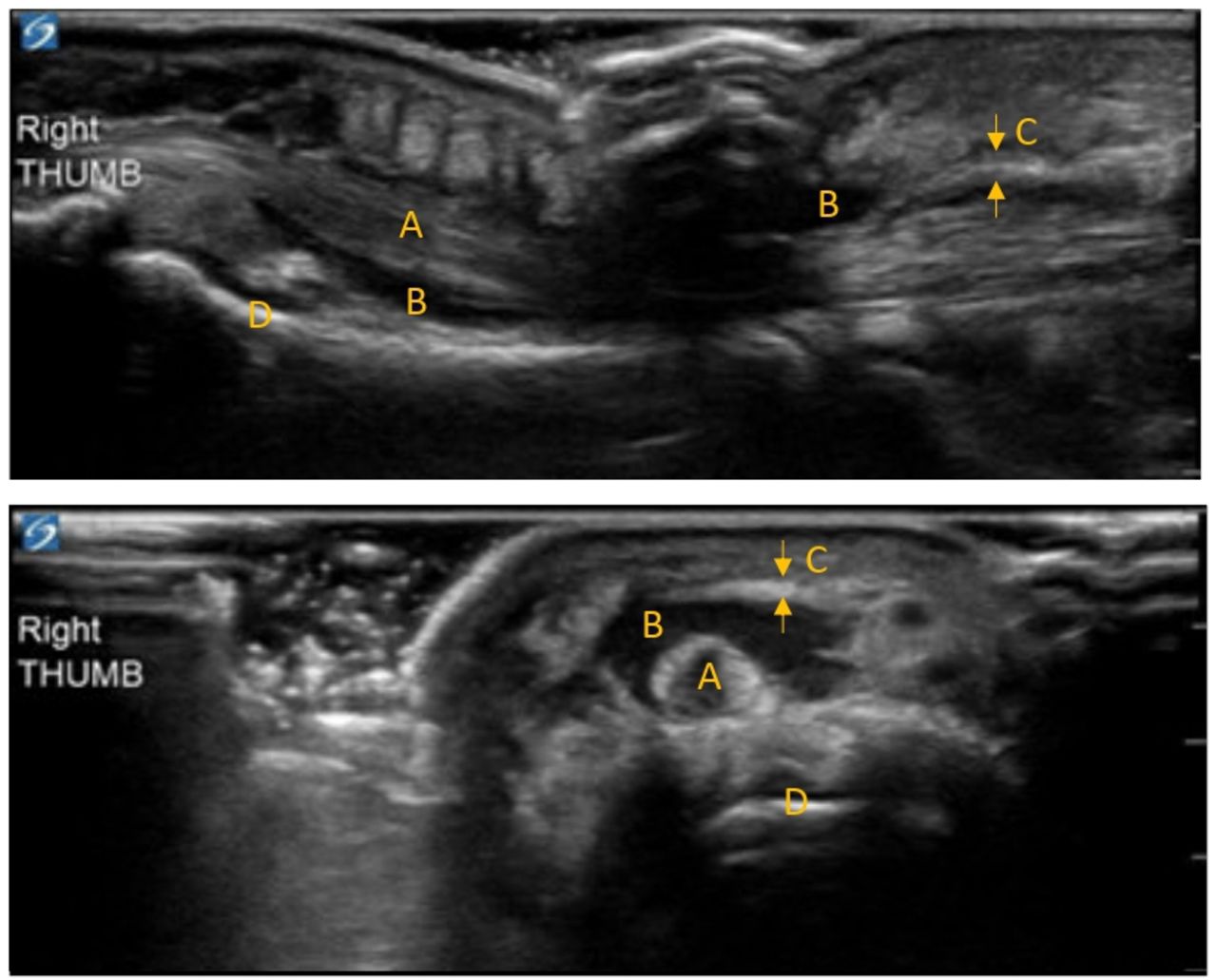Wrist Flexor Tendons Ultrasound