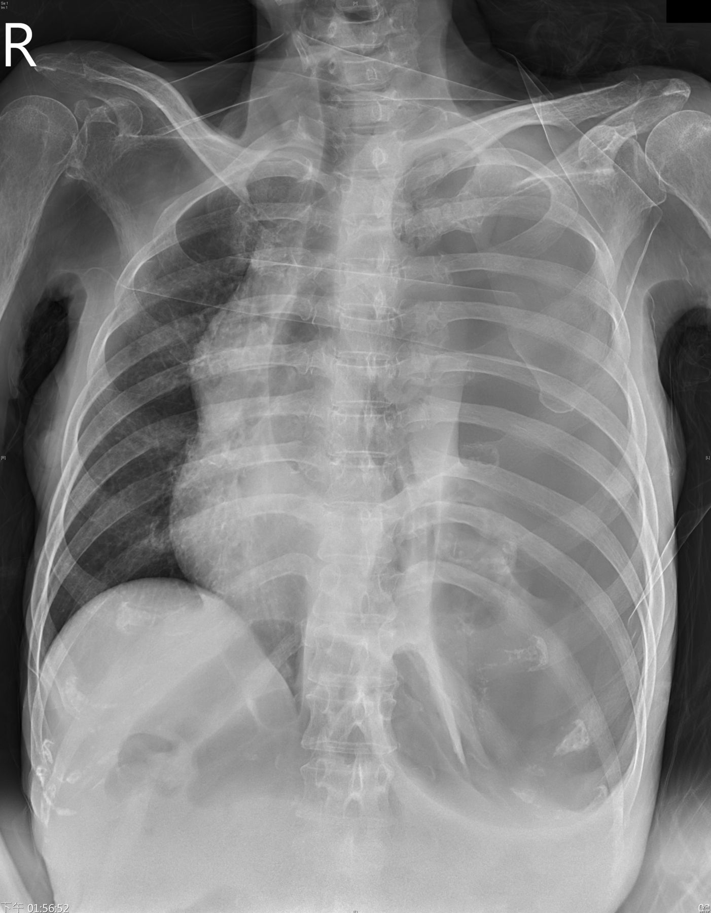 An unusual mediastinal shift | Emergency Medicine Journal