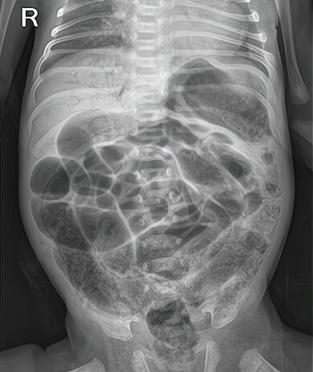 Newborn with abdominal distention | Emergency Medicine Journal